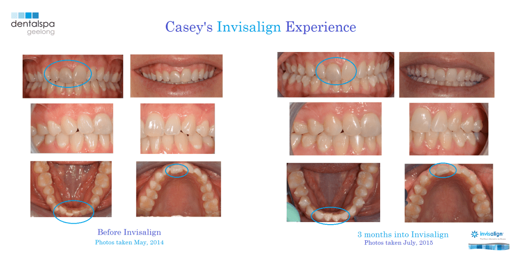Casey's Invisalign Treatment- Part 2 - Dentalspa Geelong