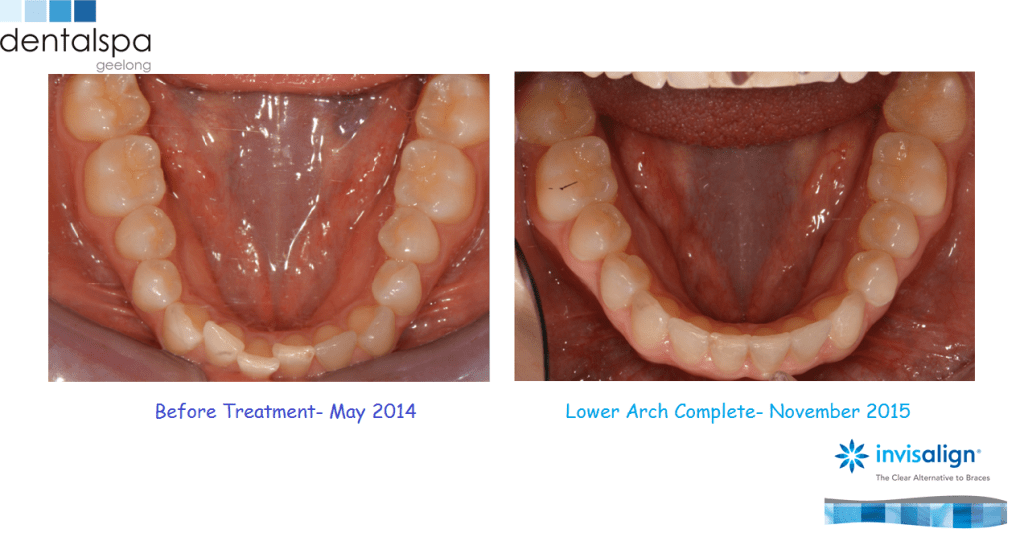 Casey's Invisalign treatment- part 3 - Dentalspa Geelong