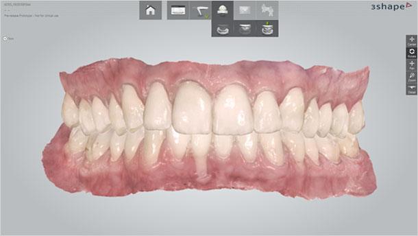 Making your dental treatment easier- intraoral 3D scanner - Dentalspa ...