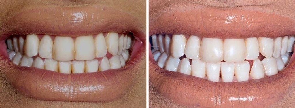 The most common causes of tooth stain - Dentalspa Geelong